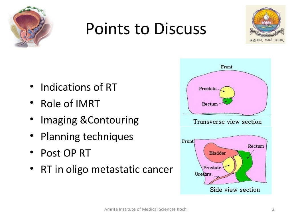 IMRT in Prostate Cancer