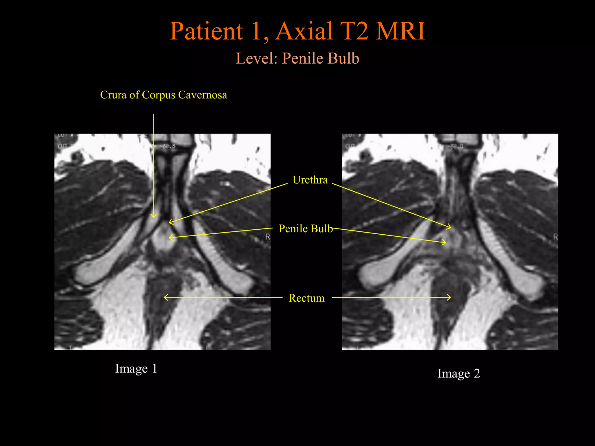 Prostate MRI anatomy from UNIVERSITY OF MICHIGAN | PPTX