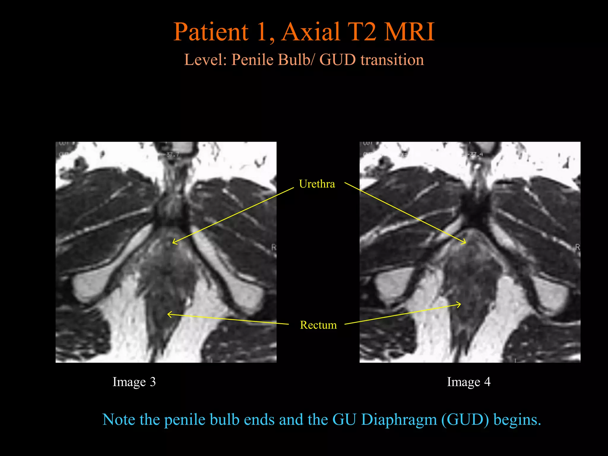 Prostate MRI anatomy from UNIVERSITY OF MICHIGAN | PPTX