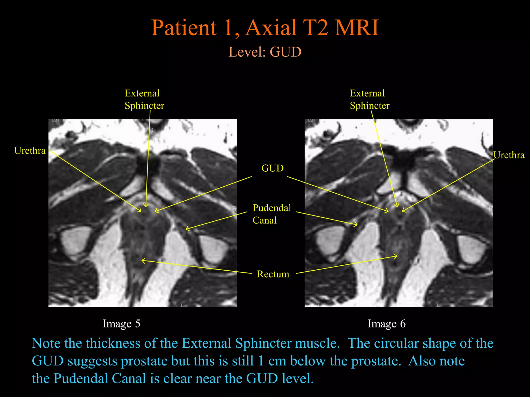Prostate MRI anatomy from UNIVERSITY OF MICHIGAN | PPTX