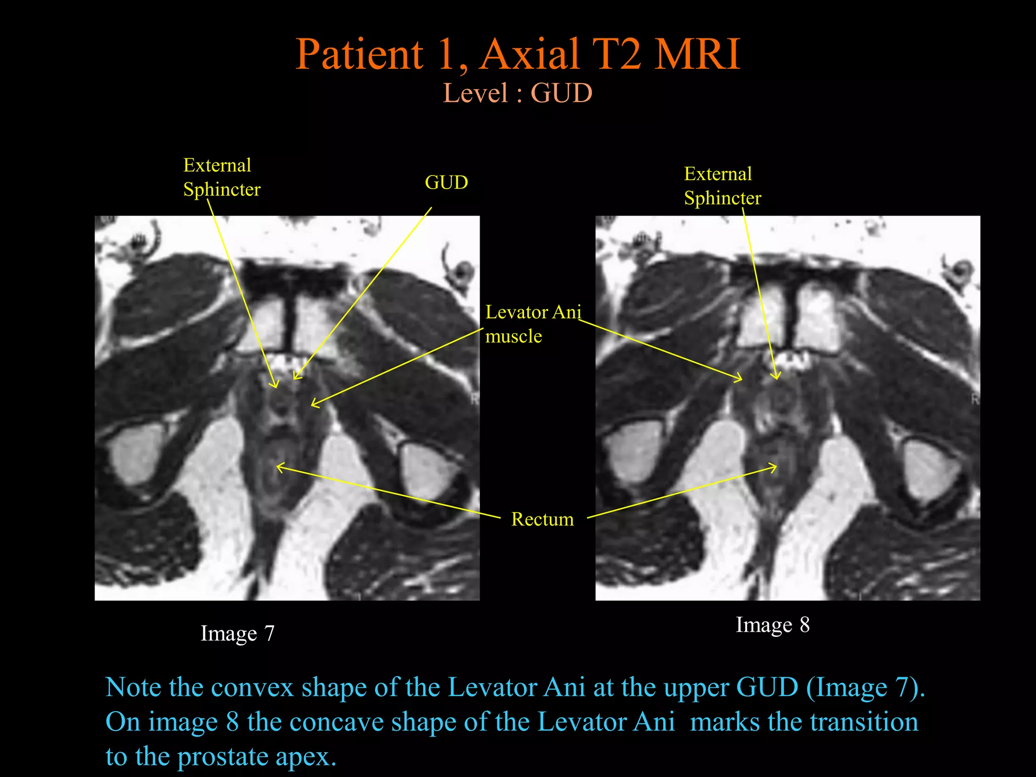 Prostate MRI anatomy from UNIVERSITY OF MICHIGAN | PPTX