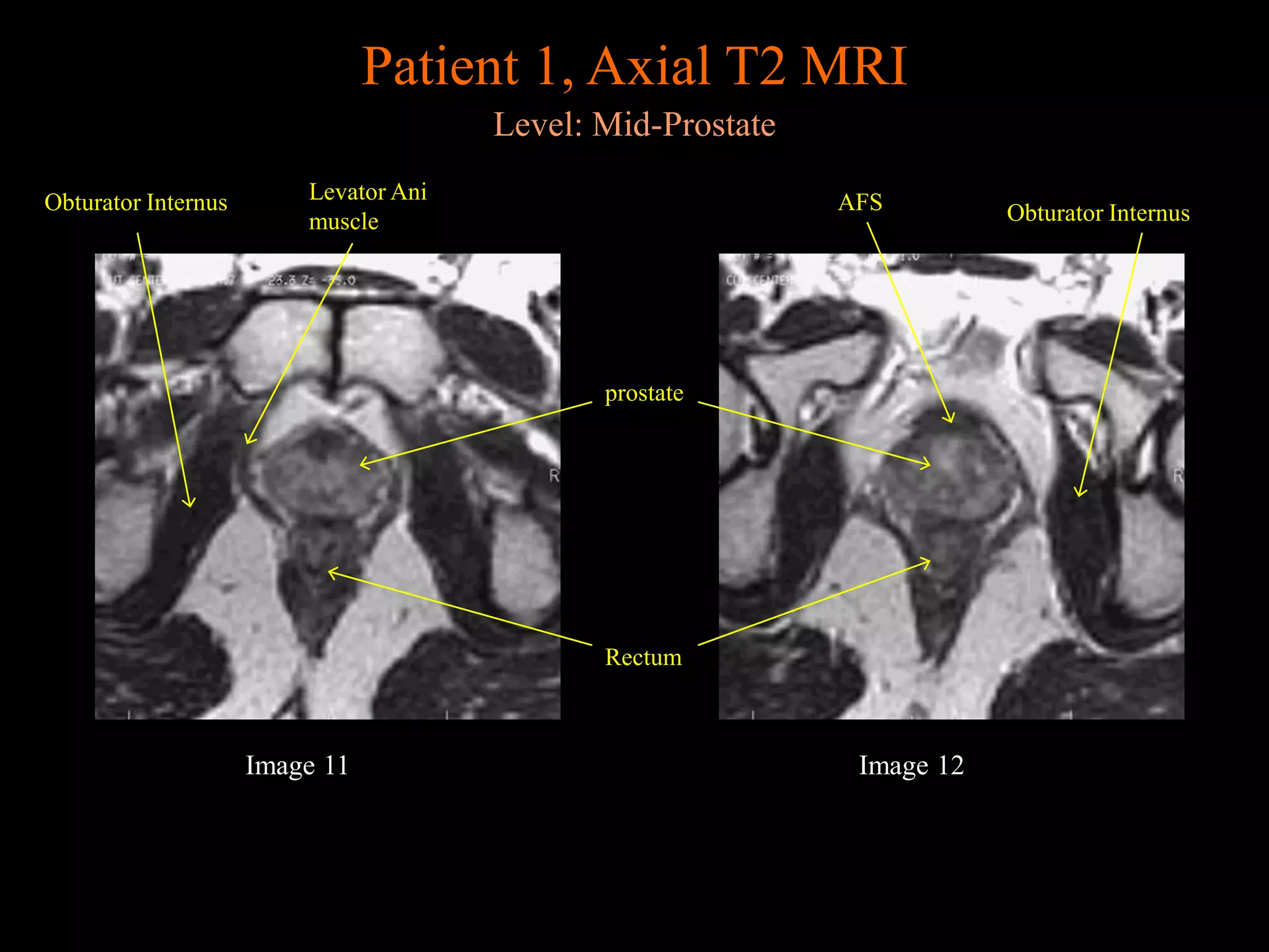 Prostate MRI anatomy from UNIVERSITY OF MICHIGAN | PPTX