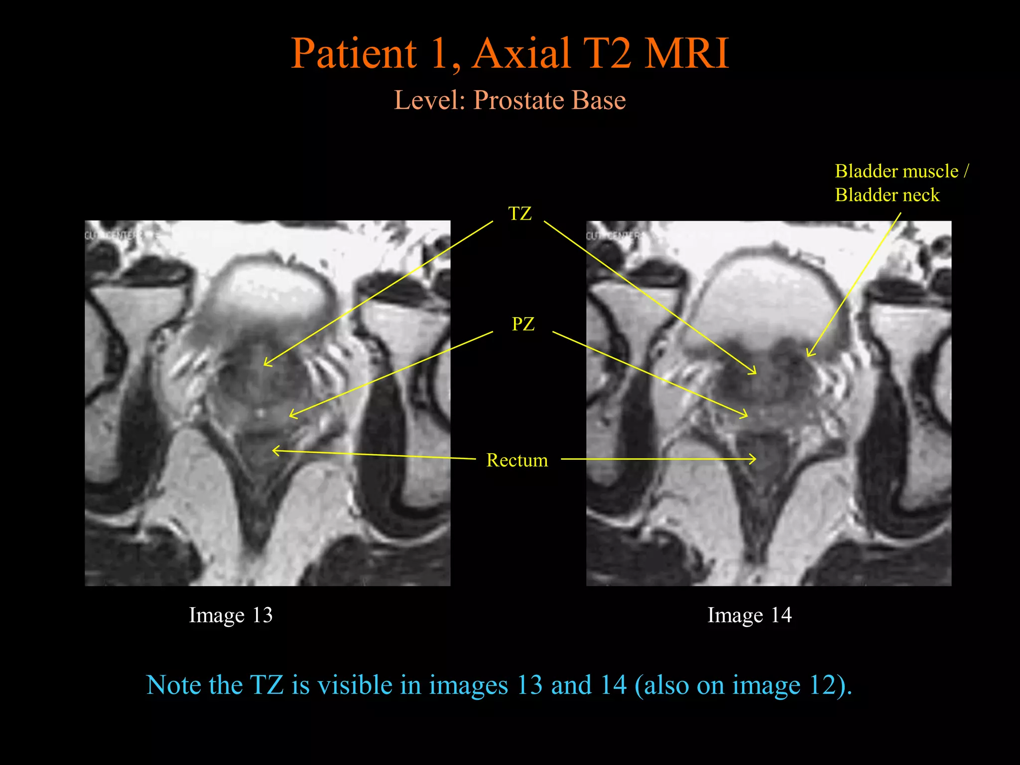 Prostate MRI anatomy from UNIVERSITY OF MICHIGAN | PPTX