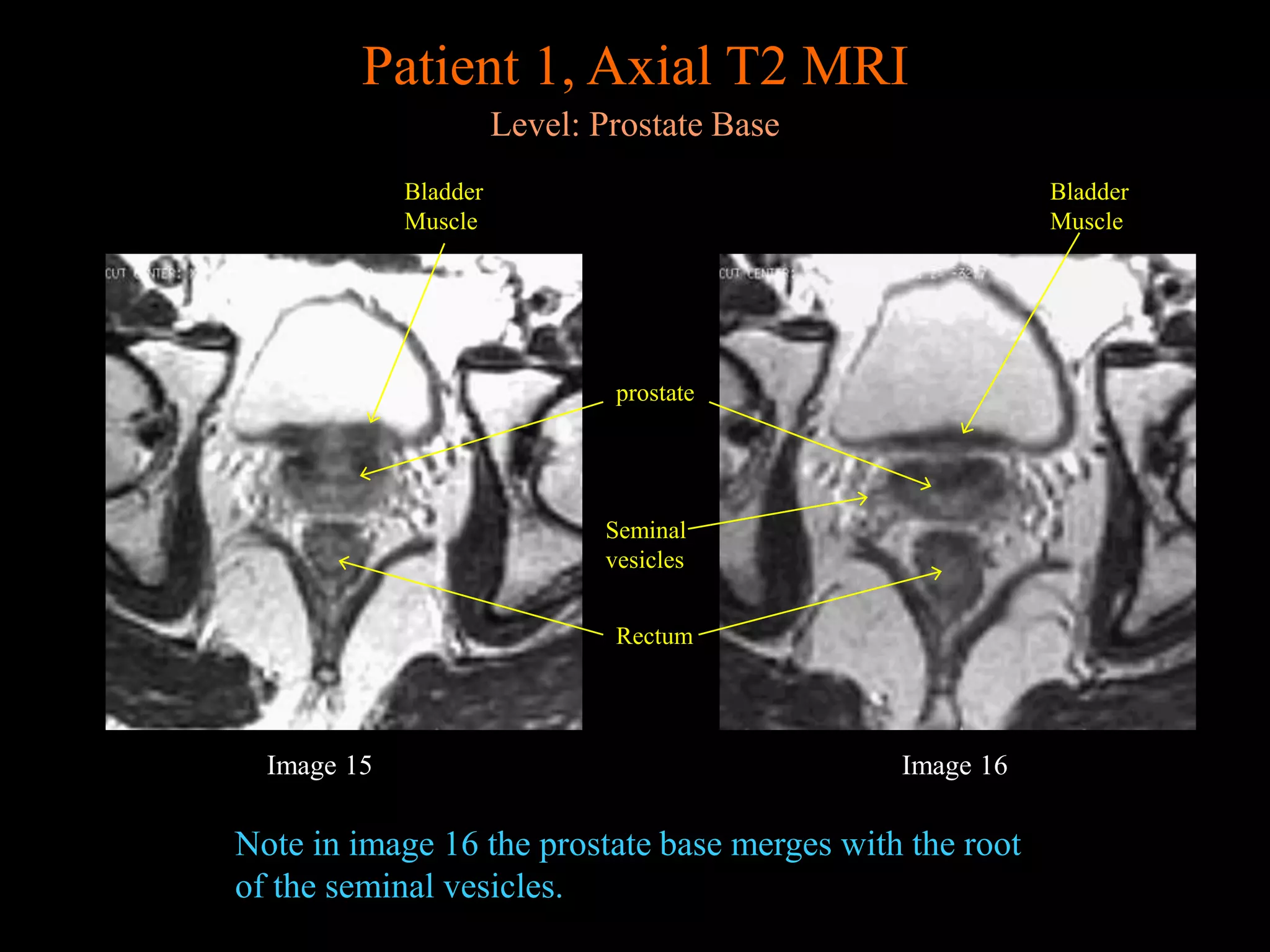 Prostate MRI anatomy from UNIVERSITY OF MICHIGAN | PPTX