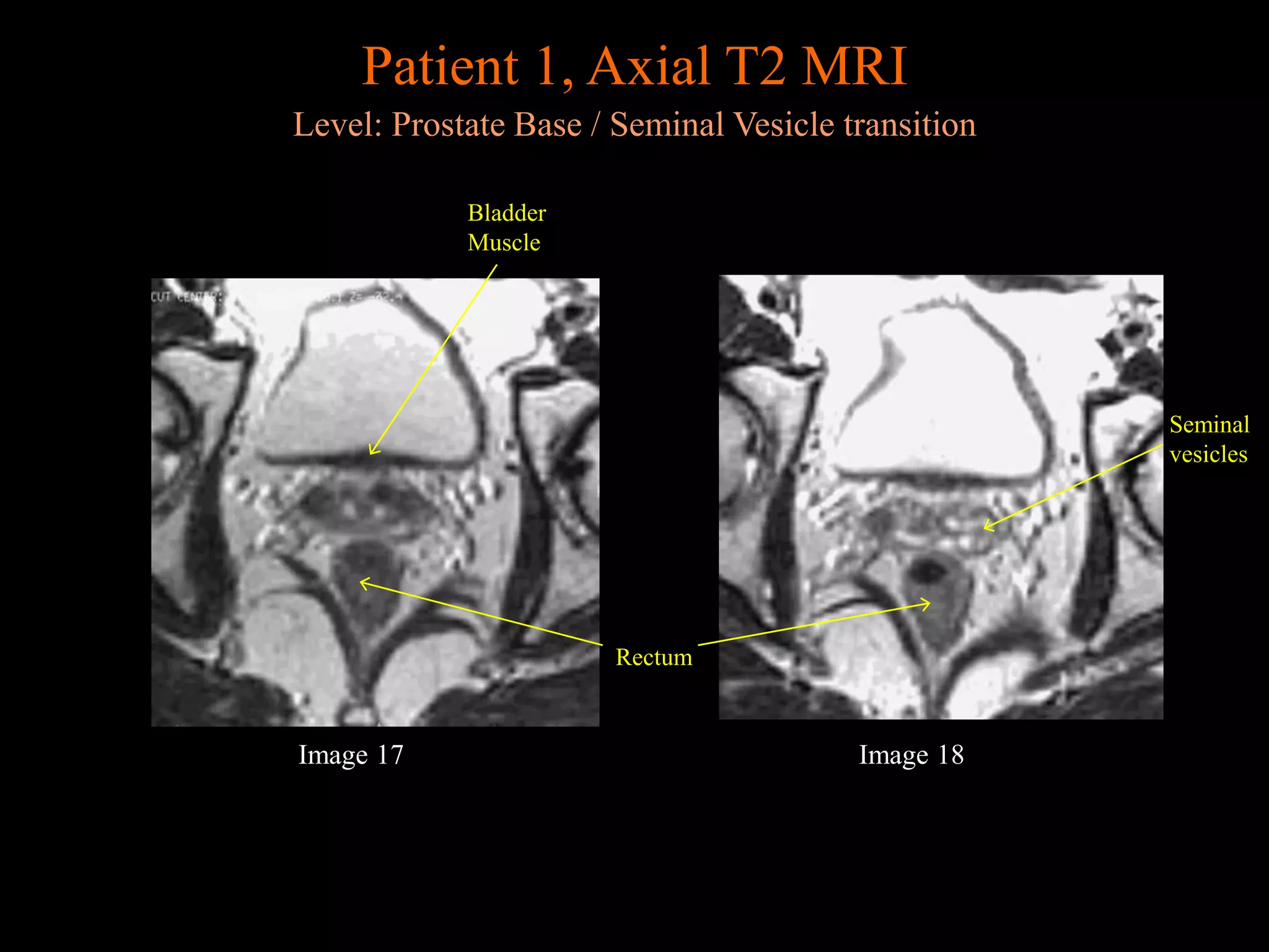 Prostate MRI anatomy from UNIVERSITY OF MICHIGAN | PPTX