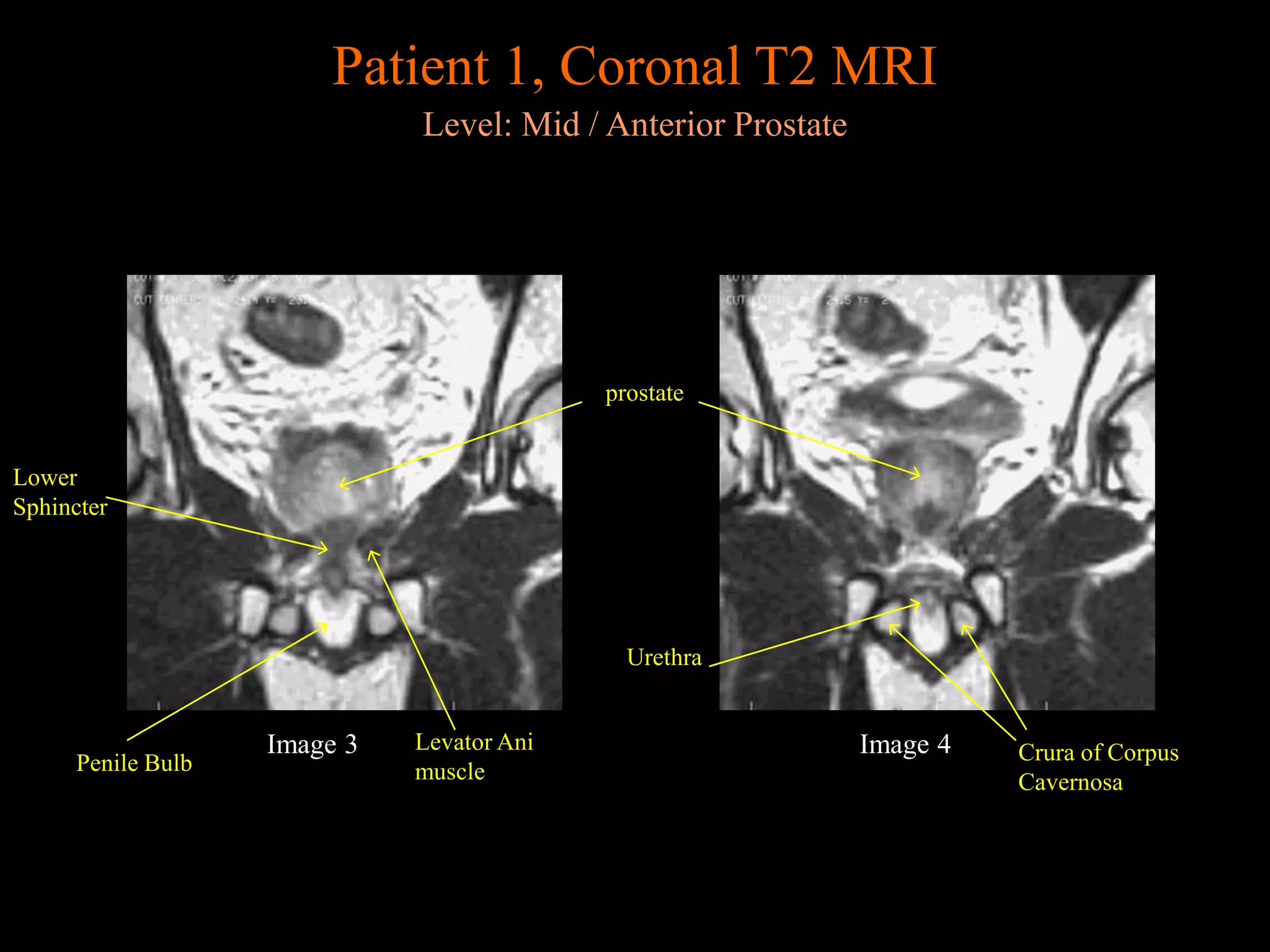 Prostate MRI anatomy from UNIVERSITY OF MICHIGAN | PPTX