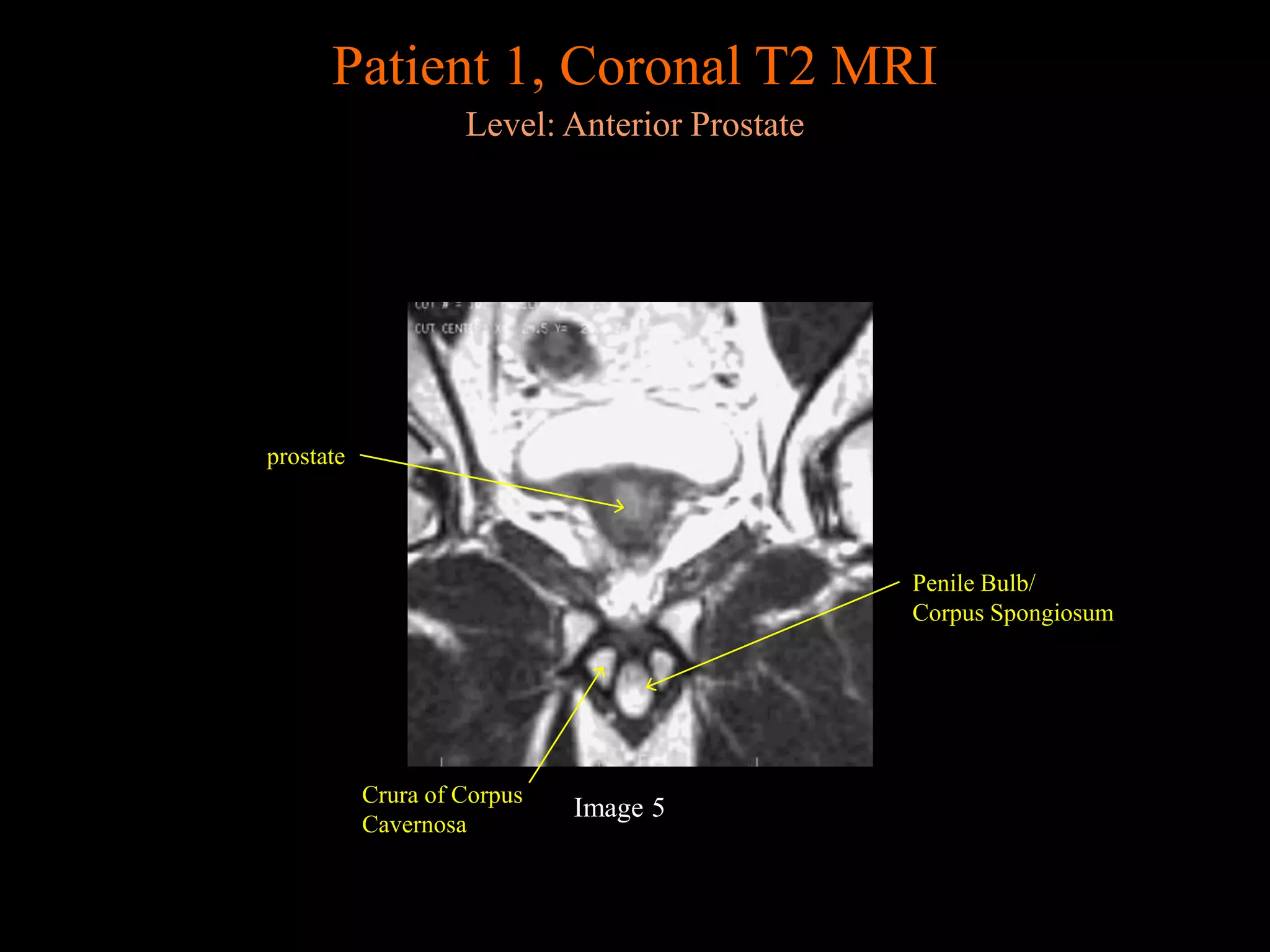 Prostate MRI anatomy from UNIVERSITY OF MICHIGAN | PPTX