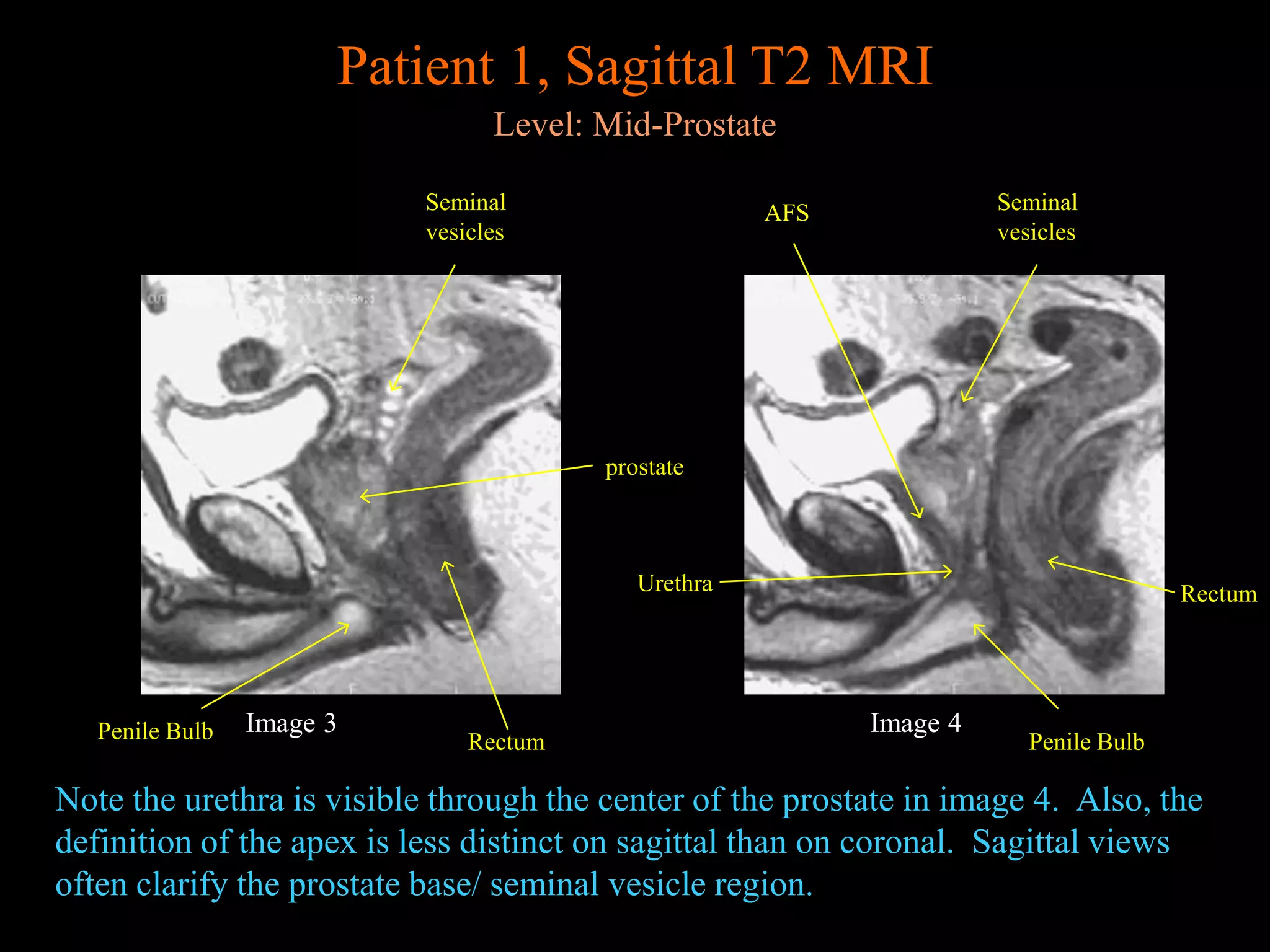Prostate MRI anatomy from UNIVERSITY OF MICHIGAN | PPTX