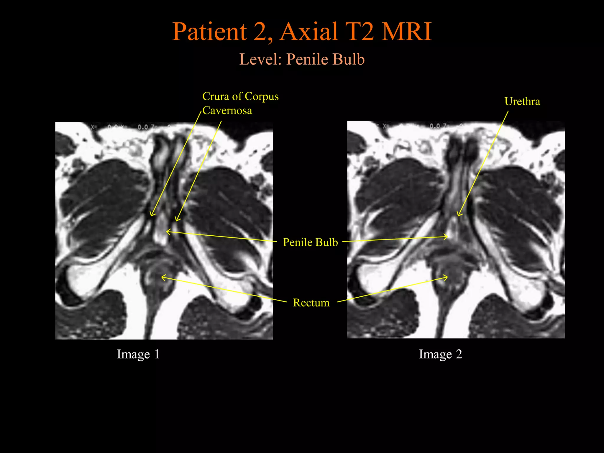 Prostate MRI anatomy from UNIVERSITY OF MICHIGAN | PPTX
