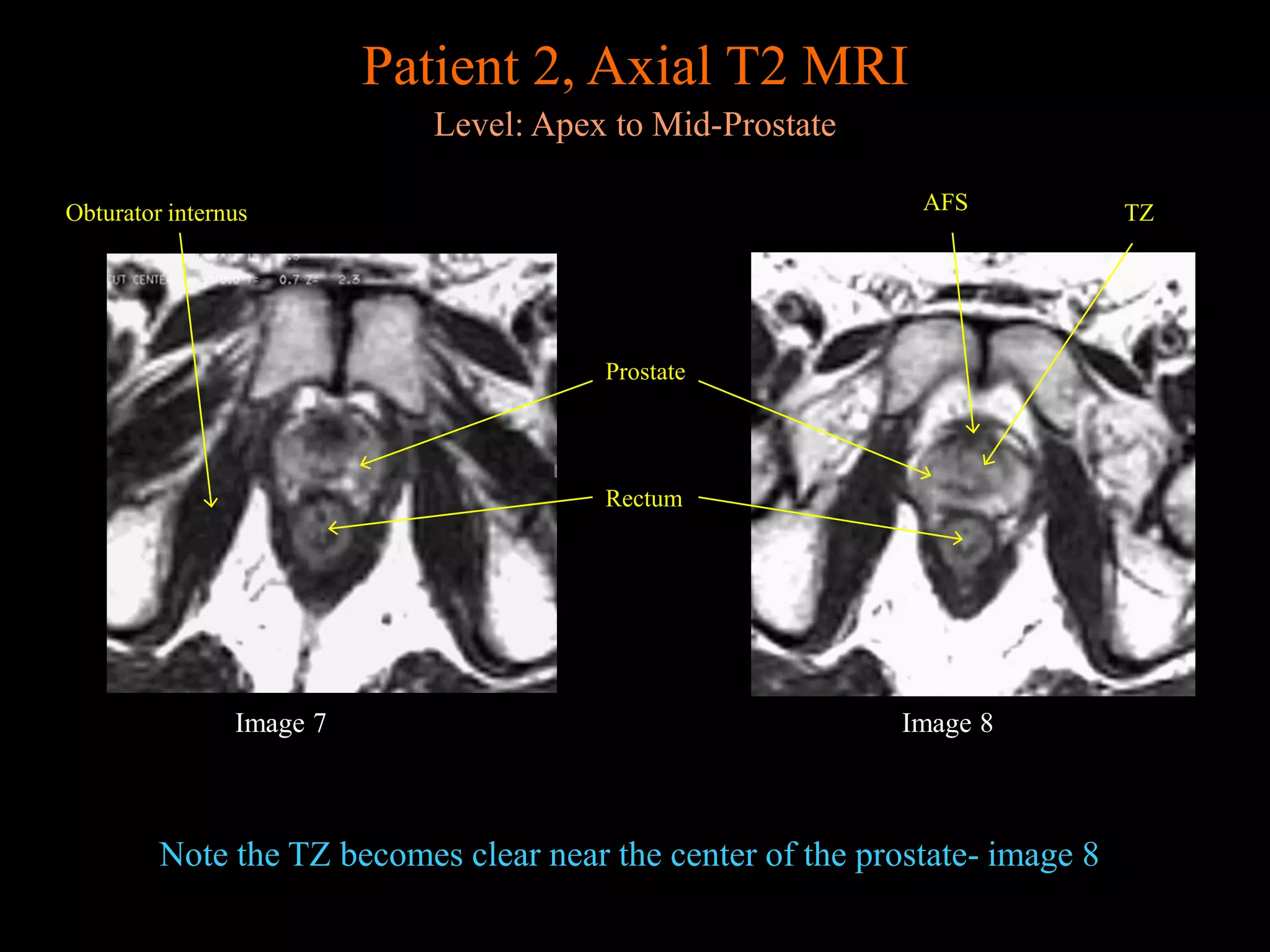 Prostate MRI anatomy from UNIVERSITY OF MICHIGAN | PPTX