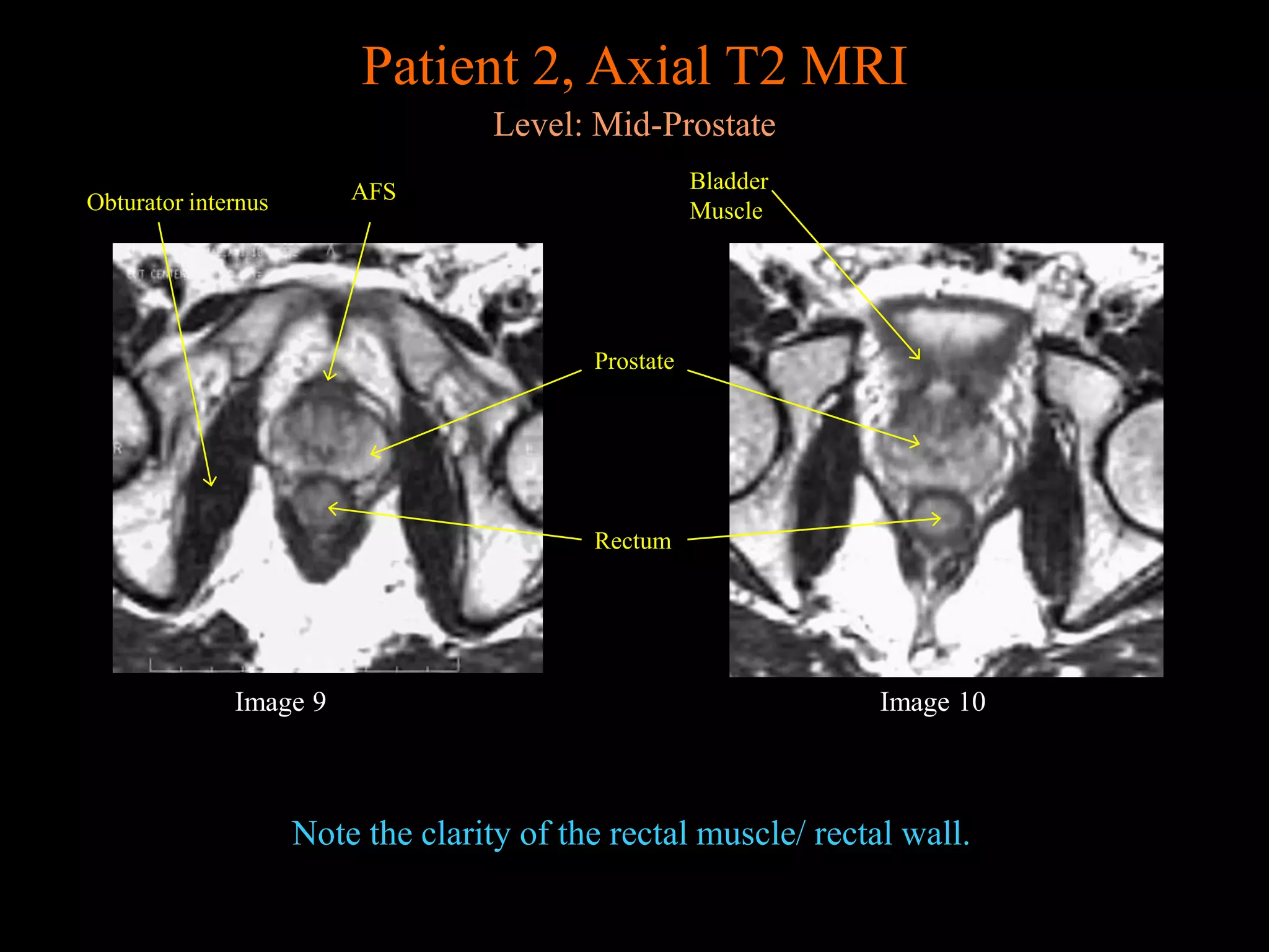 Prostate MRI anatomy from UNIVERSITY OF MICHIGAN | PPTX