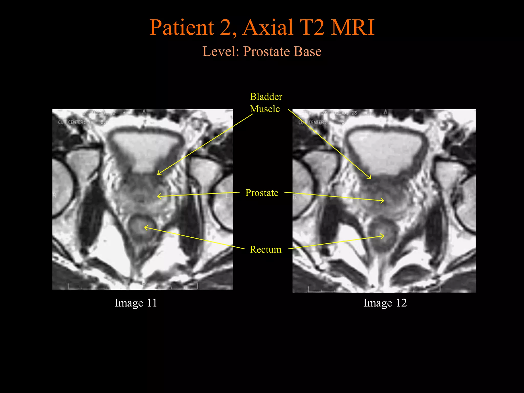 Prostate MRI anatomy from UNIVERSITY OF MICHIGAN | PPTX