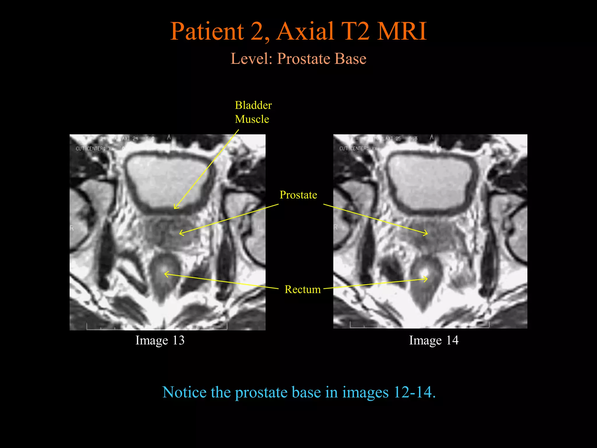 Prostate MRI anatomy from UNIVERSITY OF MICHIGAN | PPTX