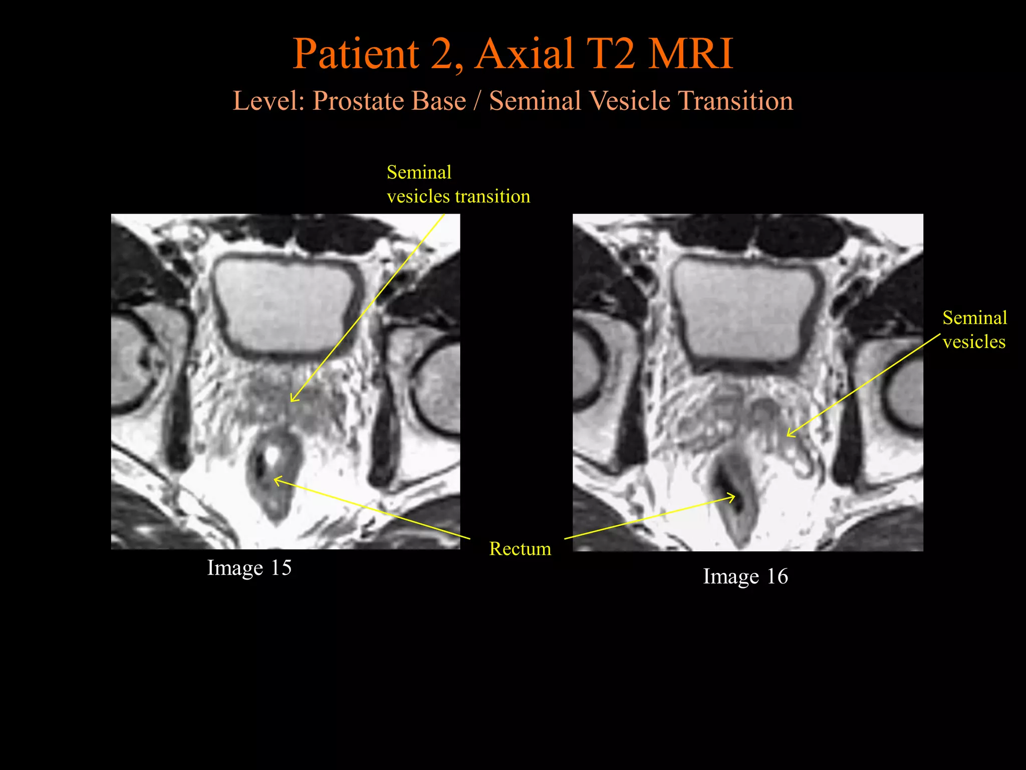 Prostate MRI anatomy from UNIVERSITY OF MICHIGAN | PPTX