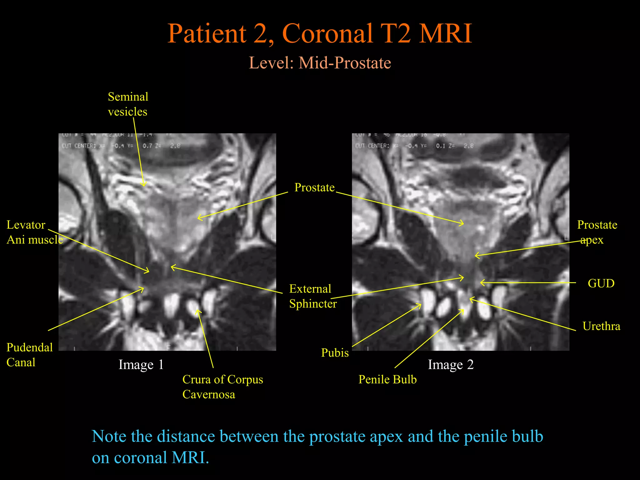 Prostate MRI anatomy from UNIVERSITY OF MICHIGAN | PPTX