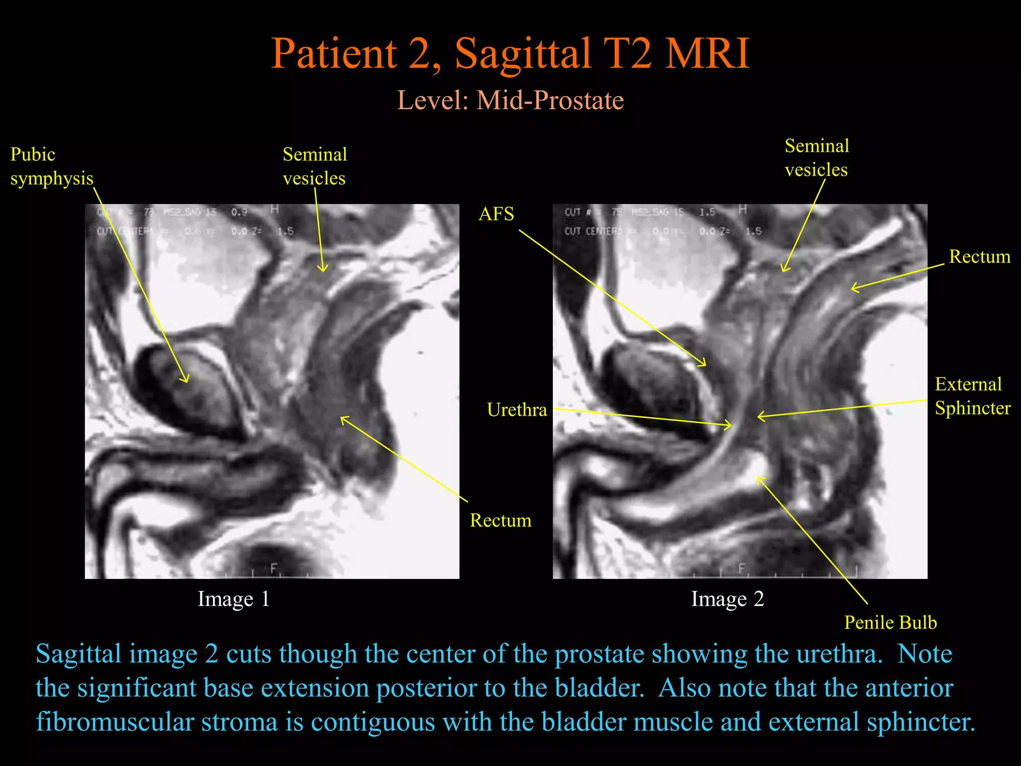 Prostate MRI anatomy from UNIVERSITY OF MICHIGAN | PPTX