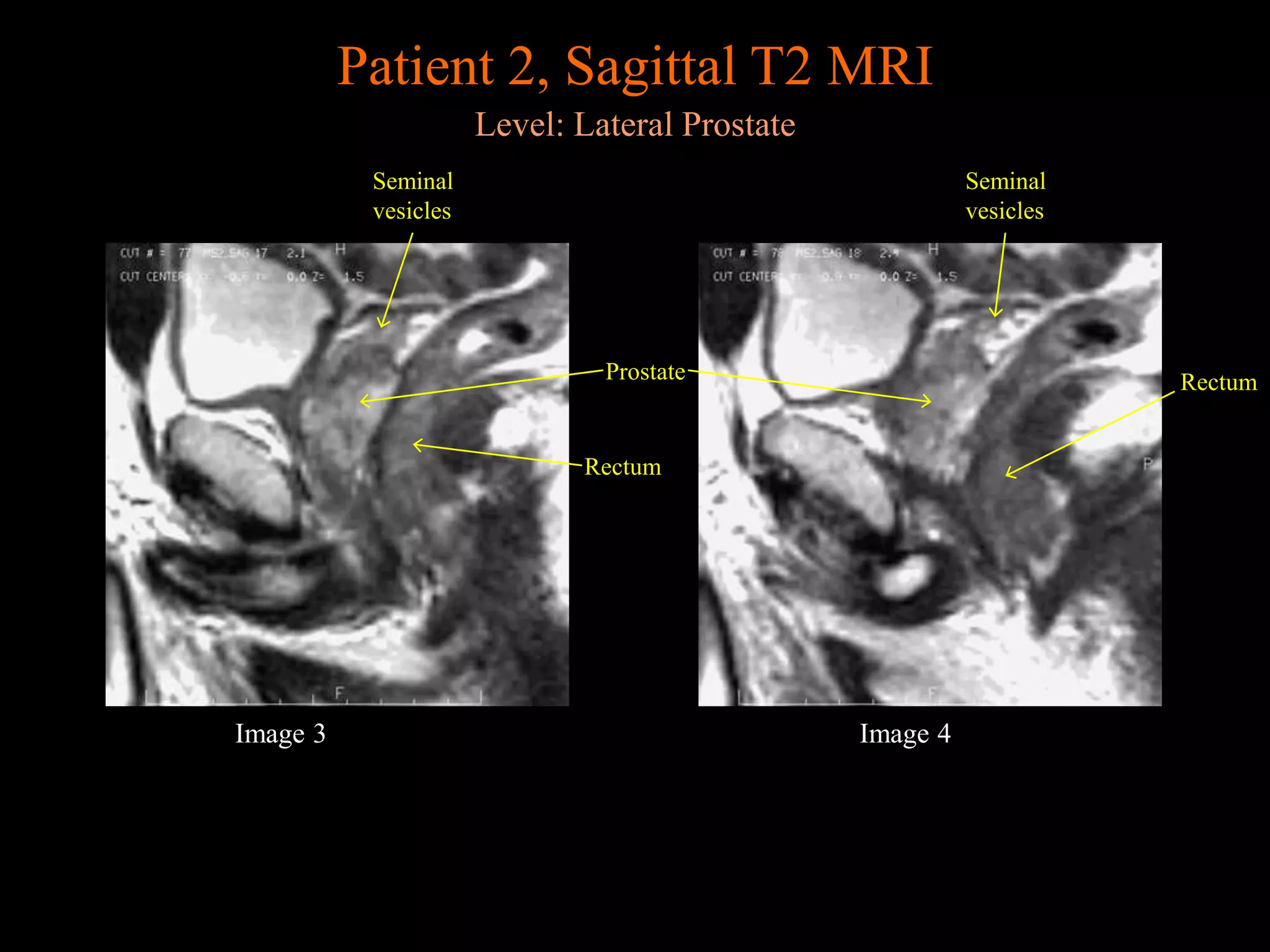 Prostate MRI anatomy from UNIVERSITY OF MICHIGAN | PPTX