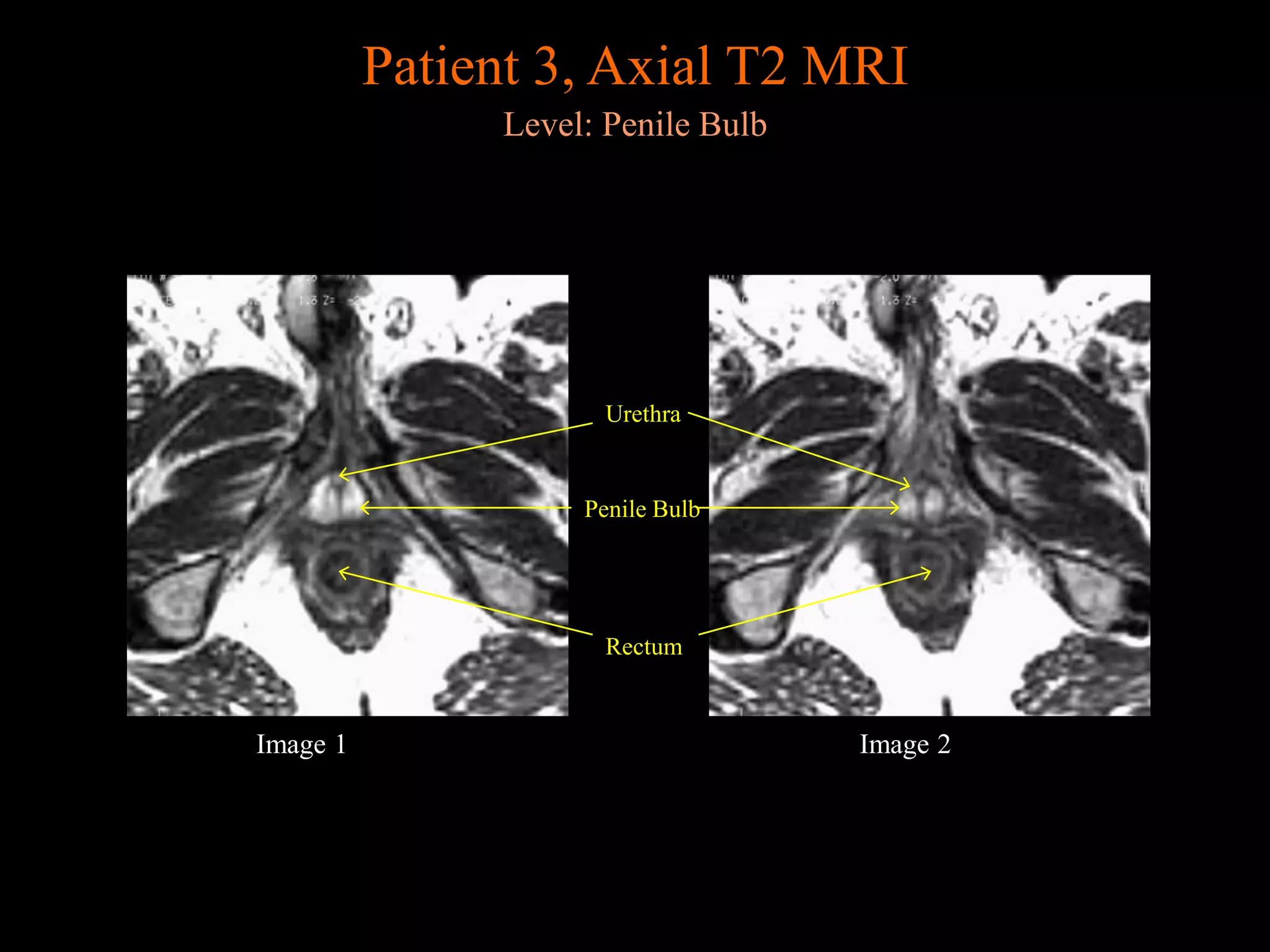 Prostate MRI anatomy from UNIVERSITY OF MICHIGAN | PPTX