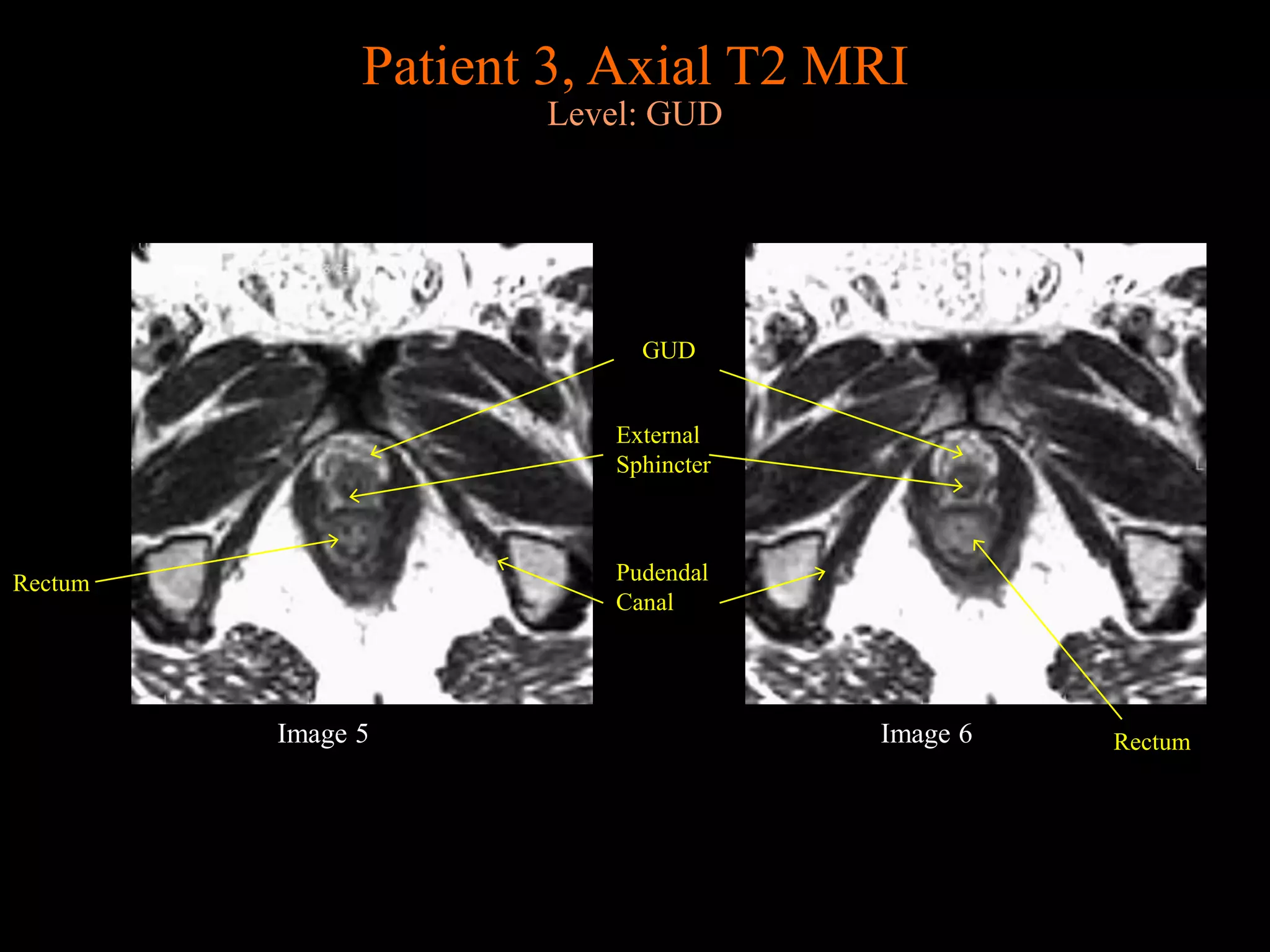 Prostate MRI anatomy from UNIVERSITY OF MICHIGAN | PPTX