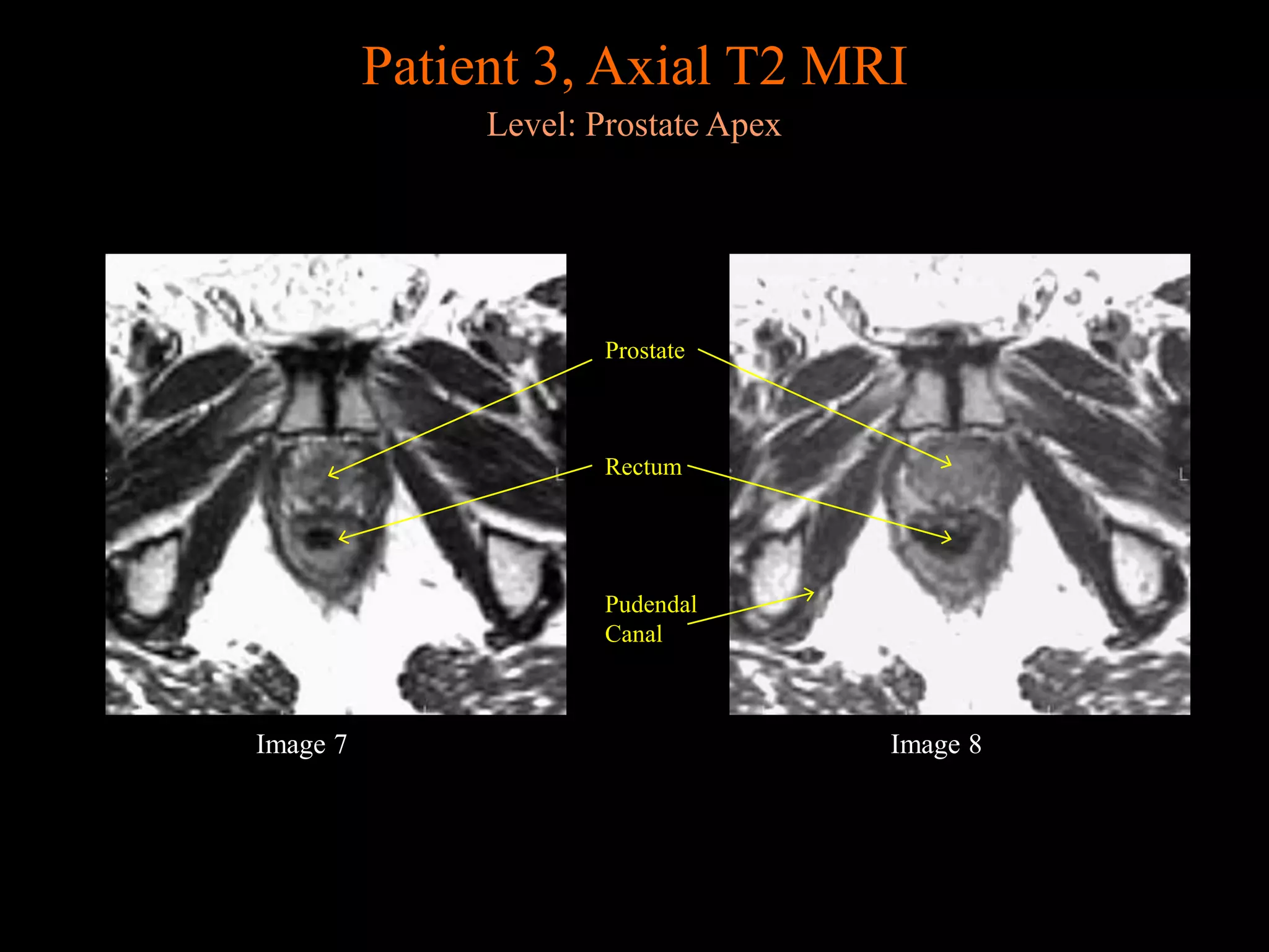 Prostate MRI anatomy from UNIVERSITY OF MICHIGAN | PPTX