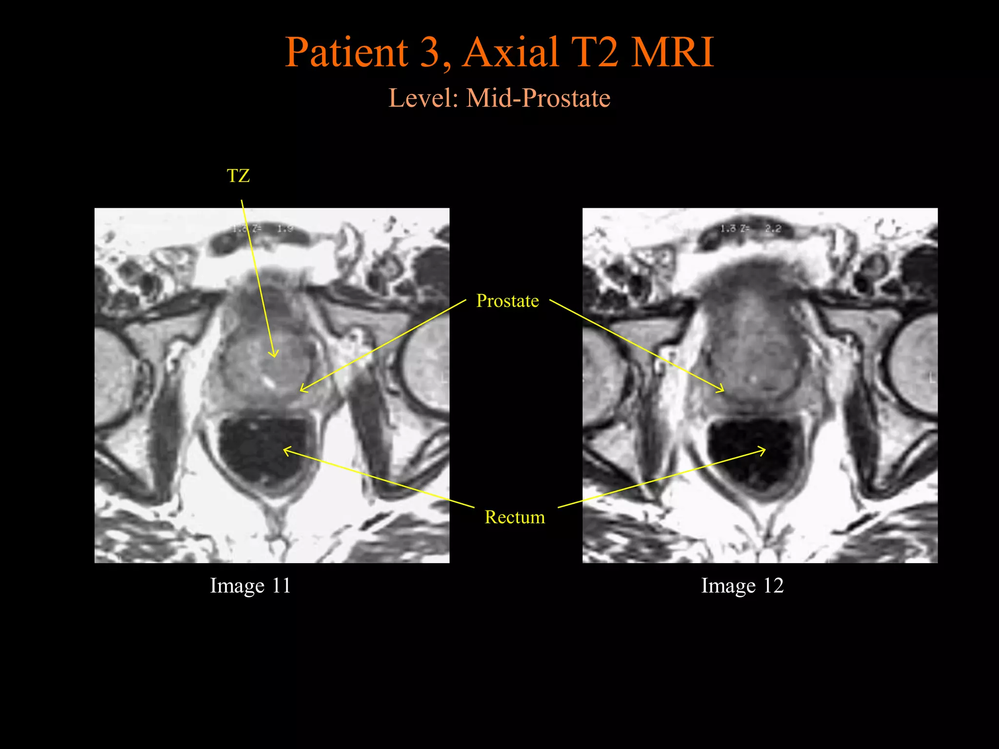 Prostate MRI anatomy from UNIVERSITY OF MICHIGAN | PPTX