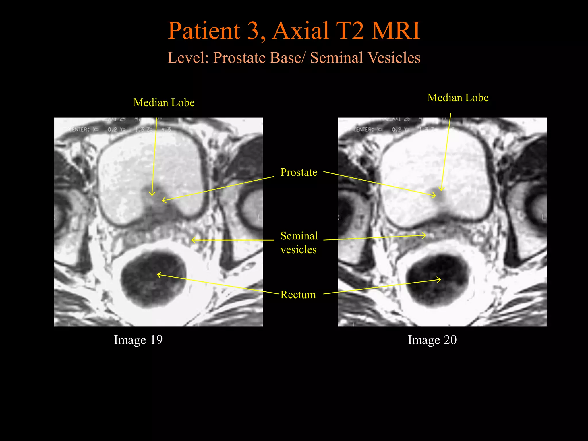 Prostate MRI anatomy from UNIVERSITY OF MICHIGAN | PPTX