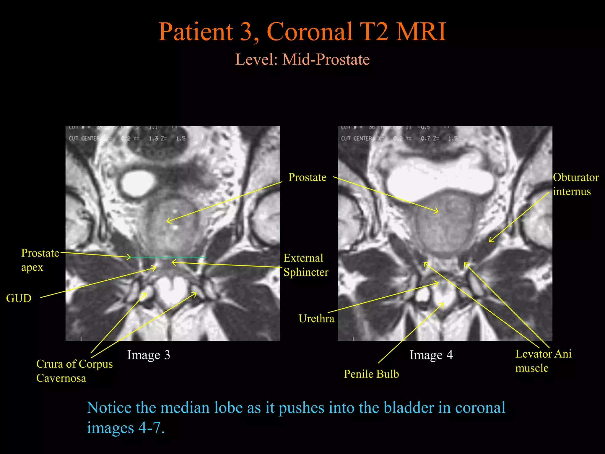 Prostate MRI anatomy from UNIVERSITY OF MICHIGAN | PPTX