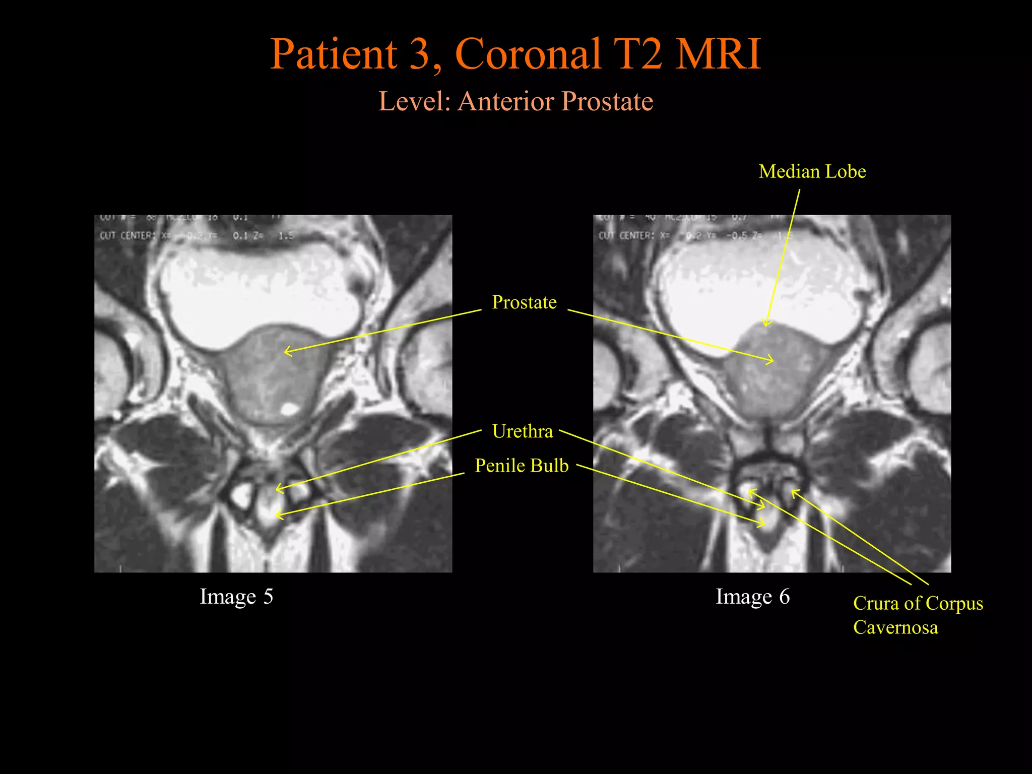 Prostate MRI anatomy from UNIVERSITY OF MICHIGAN | PPTX