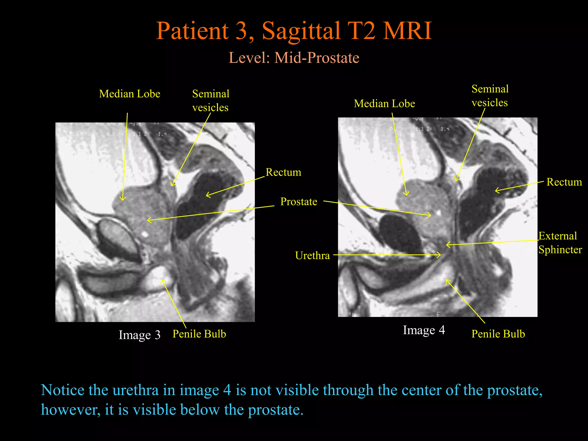 Prostate MRI anatomy from UNIVERSITY OF MICHIGAN | PPTX