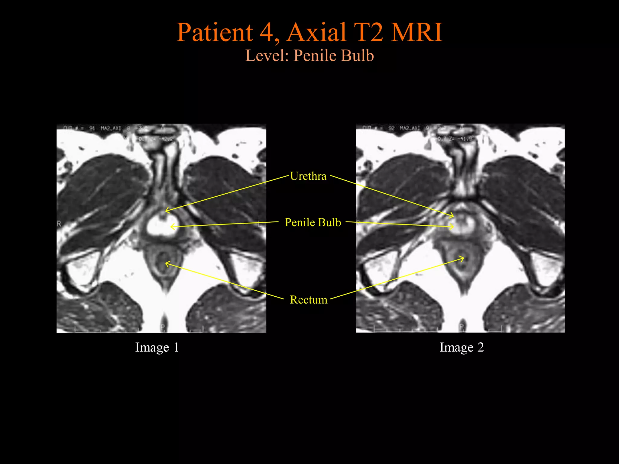 Prostate MRI anatomy from UNIVERSITY OF MICHIGAN | PPTX