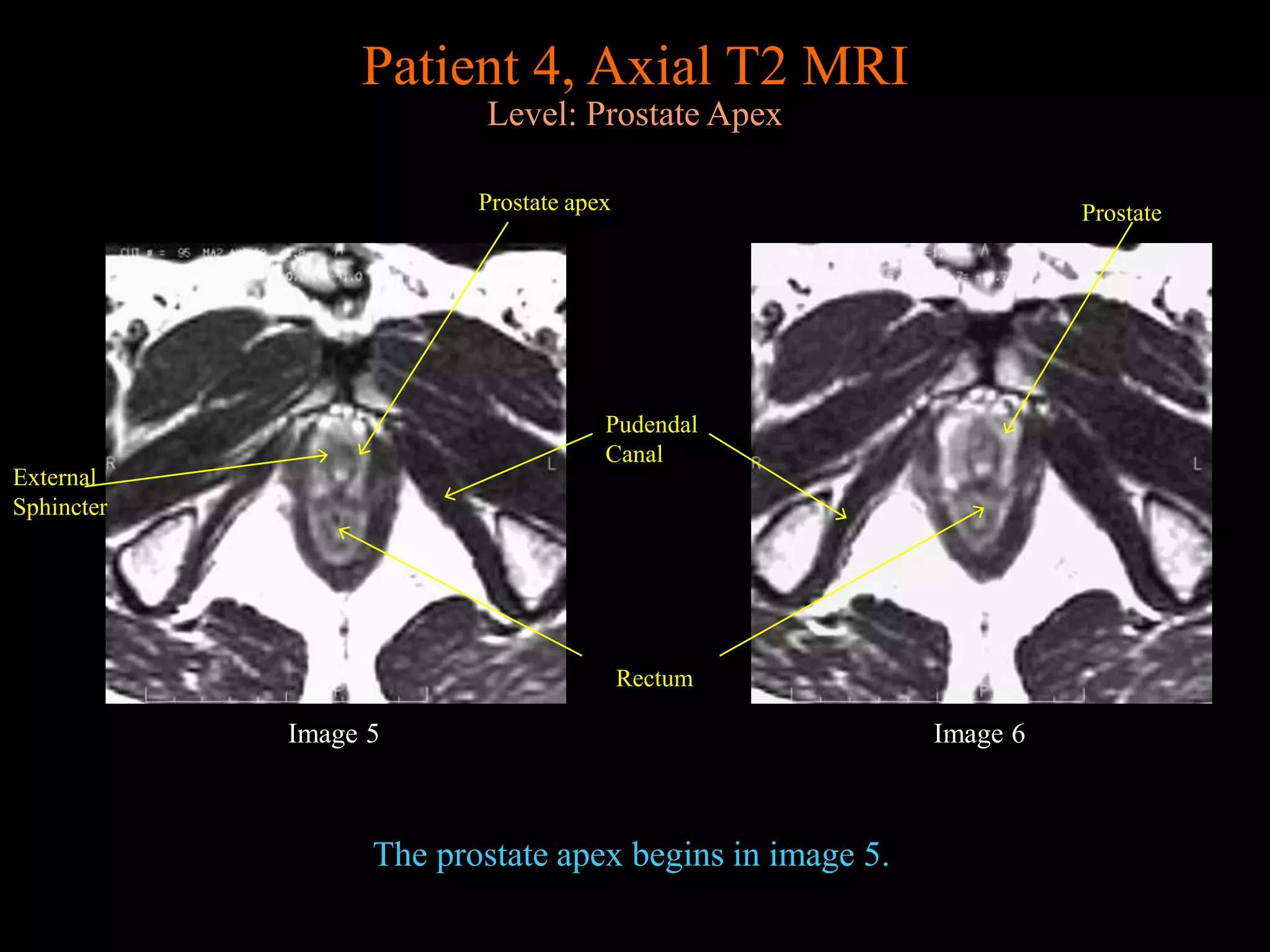 Prostate MRI anatomy from UNIVERSITY OF MICHIGAN | PPTX