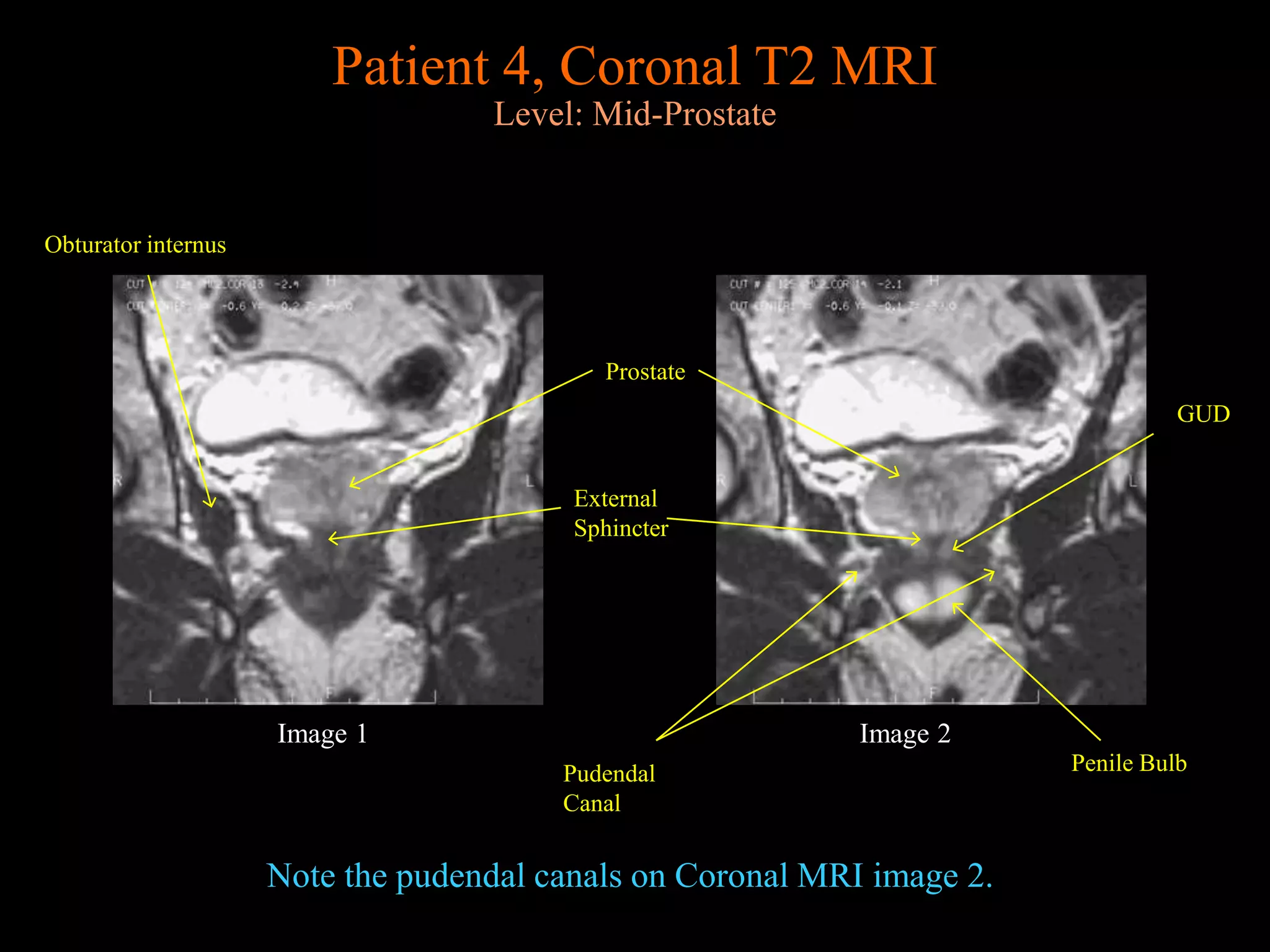 Prostate MRI anatomy from UNIVERSITY OF MICHIGAN | PPTX