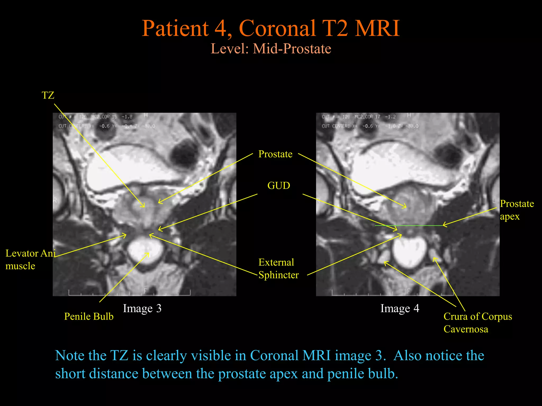 Prostate MRI anatomy from UNIVERSITY OF MICHIGAN | PPTX