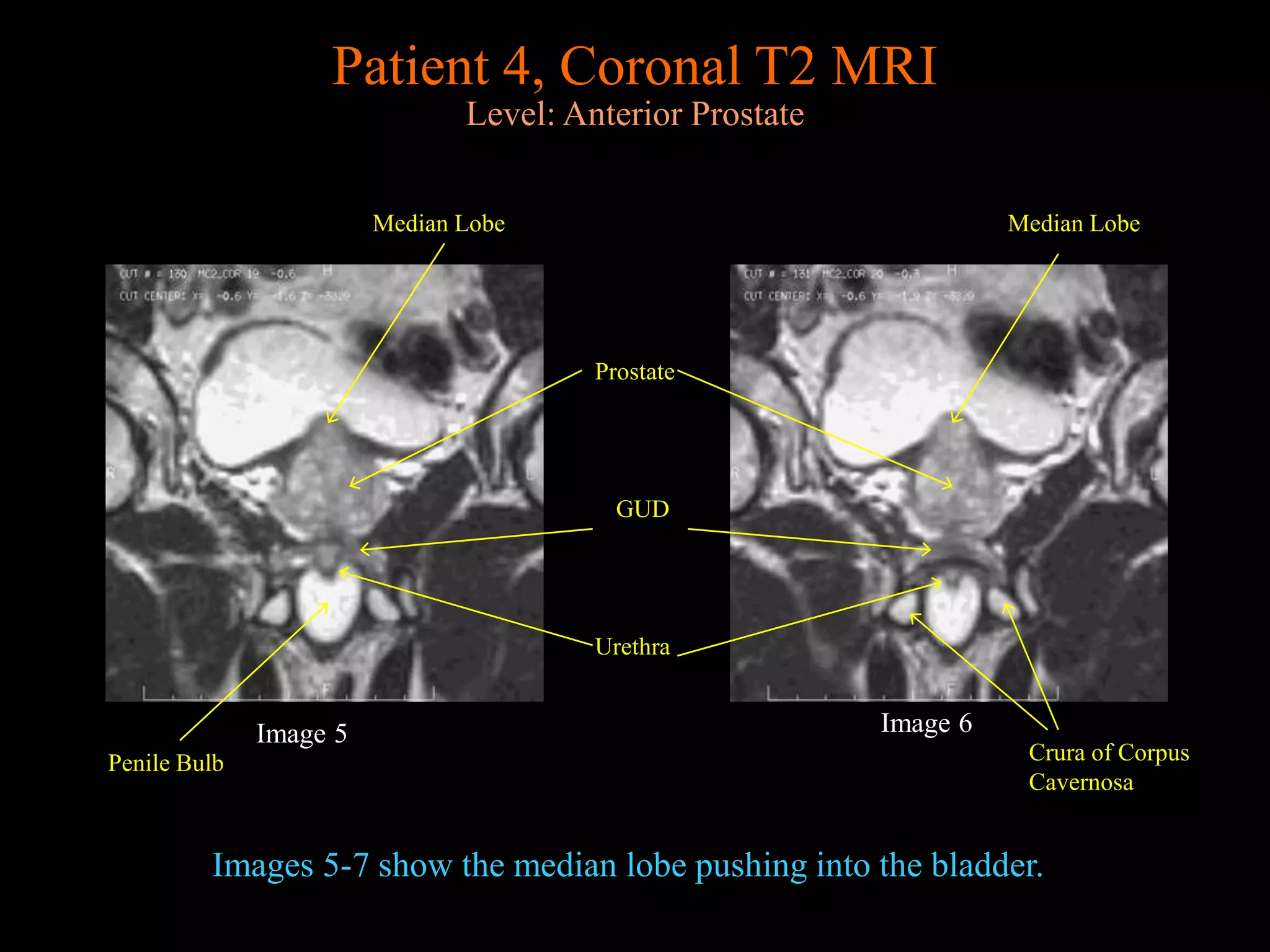Prostate MRI anatomy from UNIVERSITY OF MICHIGAN | PPTX