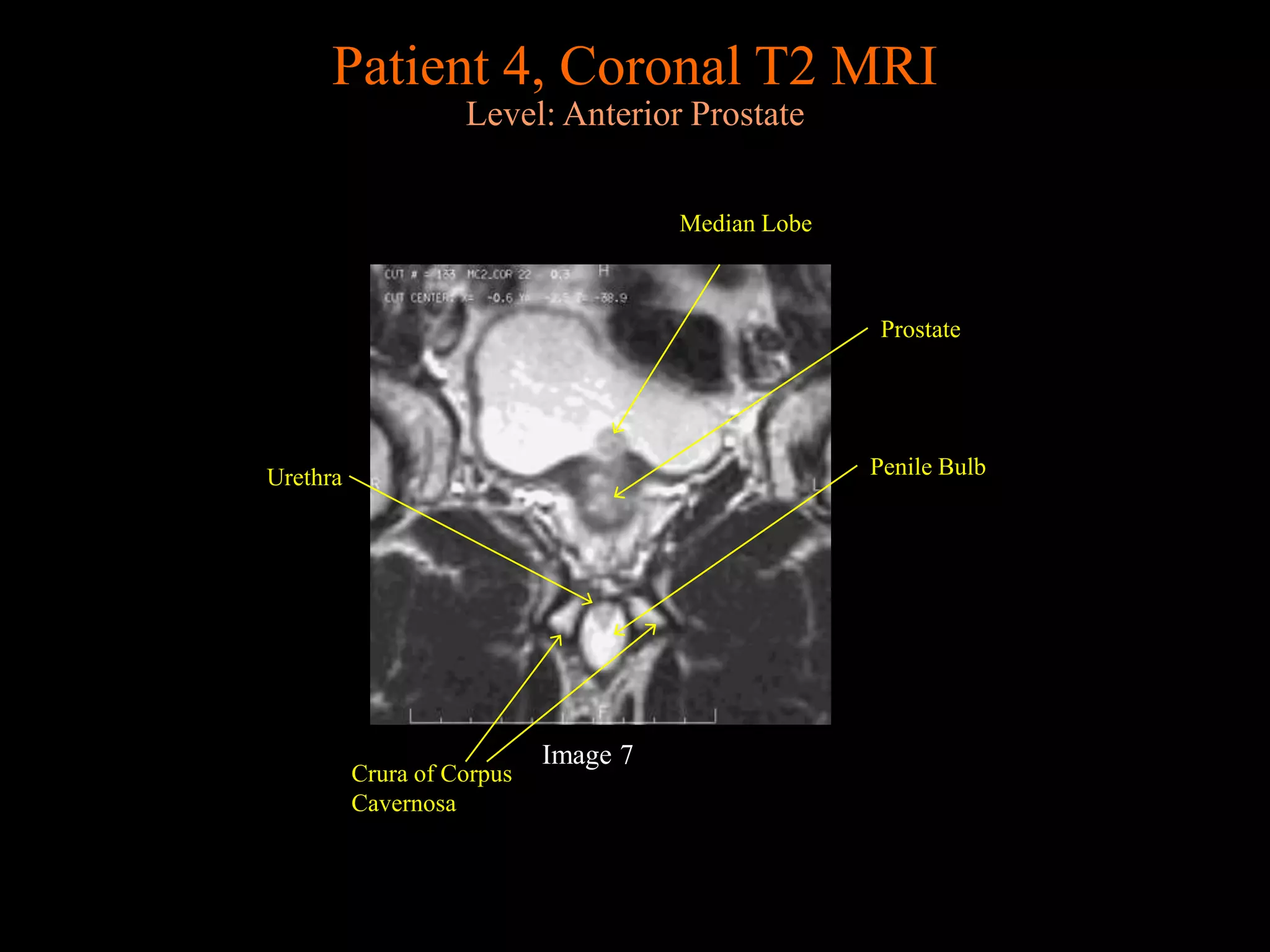 Prostate MRI anatomy from UNIVERSITY OF MICHIGAN | PPTX
