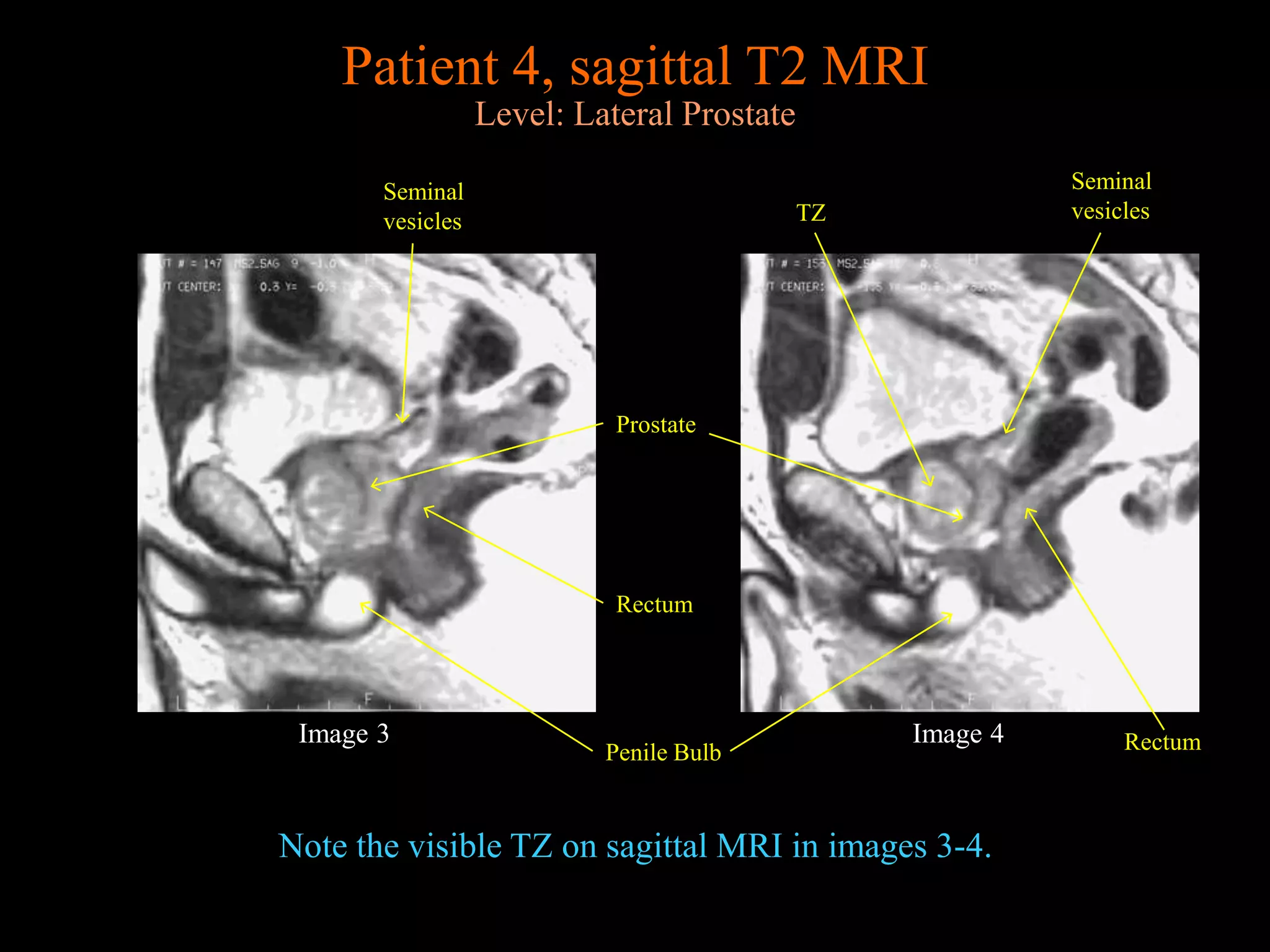 Prostate MRI anatomy from UNIVERSITY OF MICHIGAN | PPTX