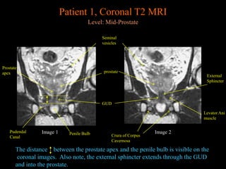 Prostate MRI anatomy from UNIVERSITY OF MICHIGAN | PPTX