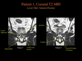 Prostate MRI anatomy from UNIVERSITY OF MICHIGAN | PPTX