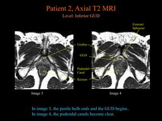 Prostate MRI anatomy from UNIVERSITY OF MICHIGAN | PPTX