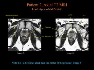 Prostate MRI anatomy from UNIVERSITY OF MICHIGAN | PPTX