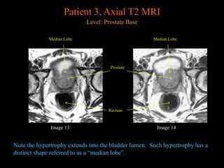 Prostate MRI anatomy from UNIVERSITY OF MICHIGAN | PPTX