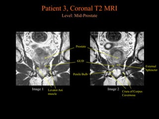 Prostate MRI anatomy from UNIVERSITY OF MICHIGAN | PPTX