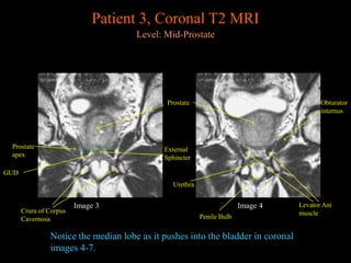 Prostate MRI anatomy from UNIVERSITY OF MICHIGAN | PPTX
