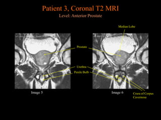 Prostate MRI anatomy from UNIVERSITY OF MICHIGAN | PPTX