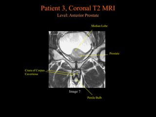 Prostate MRI anatomy from UNIVERSITY OF MICHIGAN | PPTX