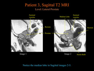 Prostate MRI anatomy from UNIVERSITY OF MICHIGAN | PPTX