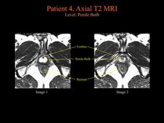 Prostate MRI anatomy from UNIVERSITY OF MICHIGAN | PPTX