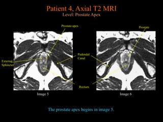 Prostate MRI anatomy from UNIVERSITY OF MICHIGAN | PPTX
