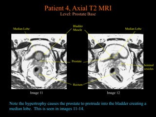 Prostate MRI anatomy from UNIVERSITY OF MICHIGAN | PPTX