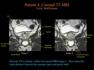 Prostate MRI anatomy from UNIVERSITY OF MICHIGAN | PPTX